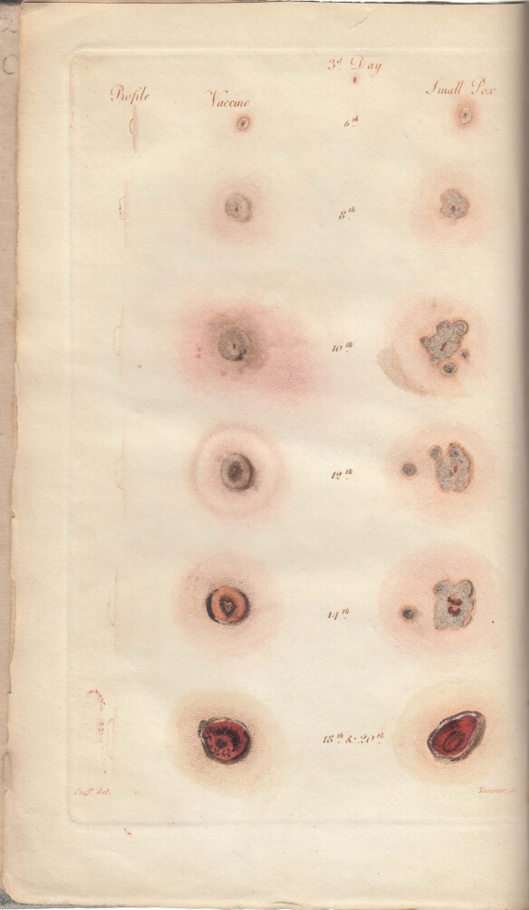 Inoculation of Smallpox | American Academy of Arts and Sciences