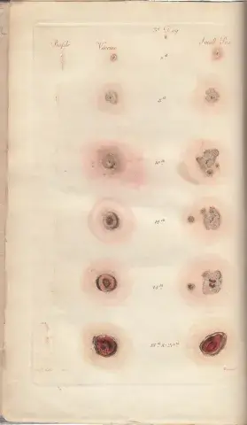 Inoculation of Smallpox | American Academy of Arts and Sciences